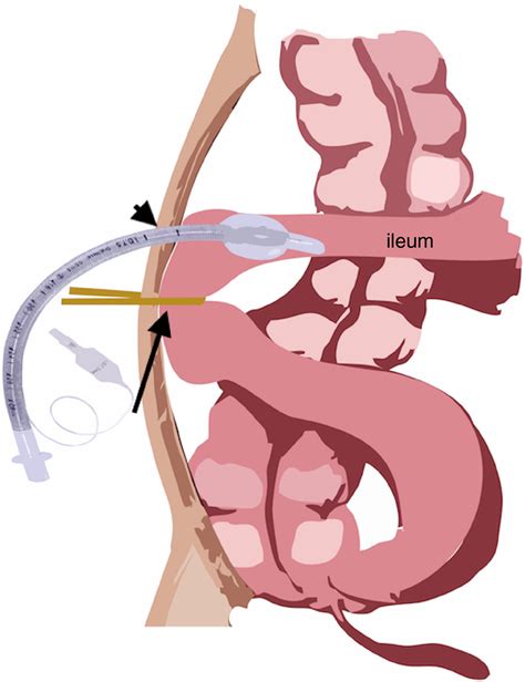 Diverting Loop Ileostomy