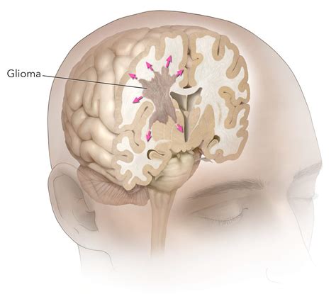 Overview Of Types Of Glioma Aaron Cohen Gadol Md