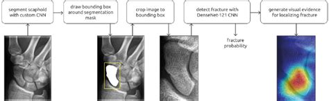 Example Of Scaphoid Fracture Detection Pipeline Which Consists Of