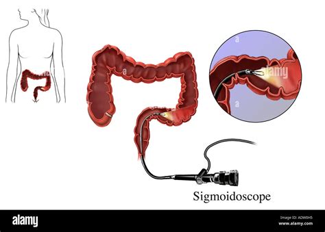Proctoscopy Vs Colonoscopy