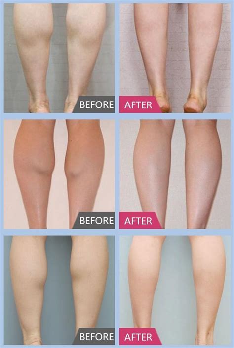 跖痛症（前脚掌疼痛）是怎么回事？ 知乎