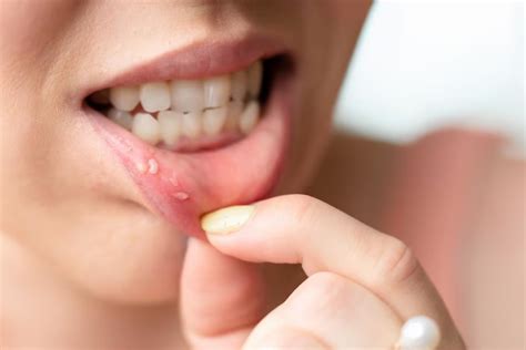 Bumps On Lips Symptoms Causes And Treatment Bumps On Lips