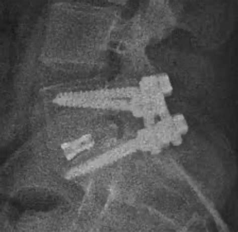 Spinal Fusion Surgery Dr Rajesh Verma Best Joint And Spine Surgeons In Gurgaon And Delhi