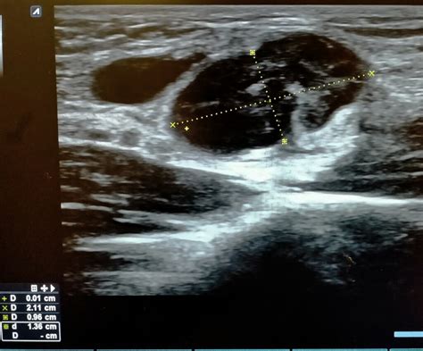 Lymphnode Echoprocedures
