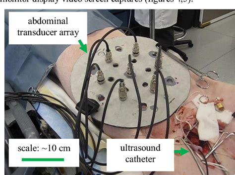 Figure 3 From Real Time 3d Catheter Localization System Using Ultrasound Recent In Vivo Results