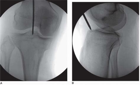 A Review Of Proximal Tibia Entry Points For Intramedullary 52 OFF