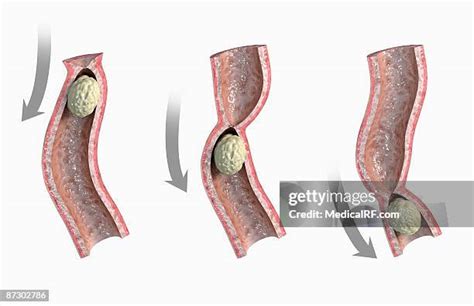 54 Peristalsis High Res Illustrations Getty Images