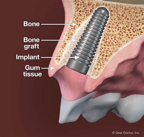 Tooth Extraction And Bone Graft At Same Time At Robert Curl Blog