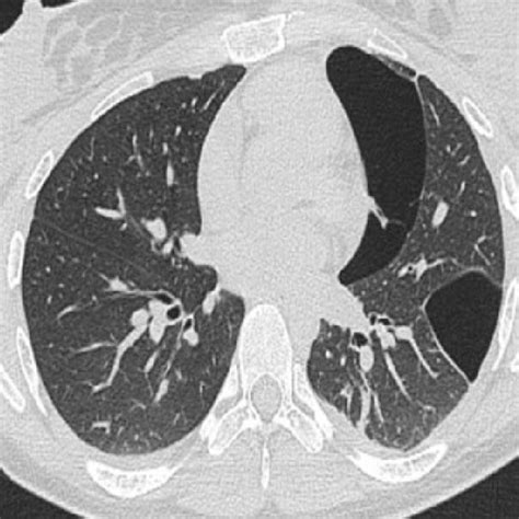 Congenital Segmental Pigmentation Disorder Of The Patient Dorsal View