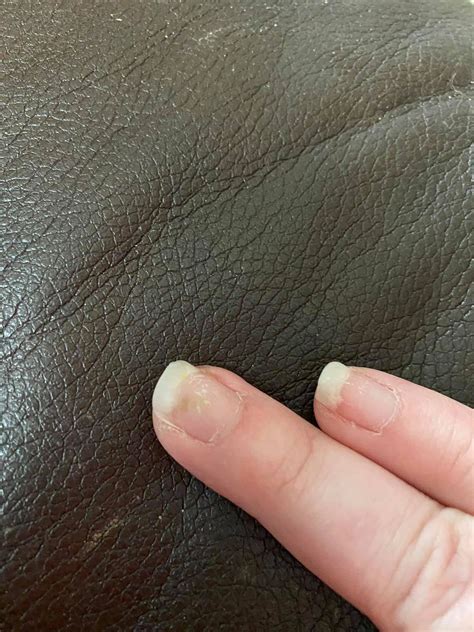 What You Need To Know About Pseudomonas Nail Infections Aka Greenies Dipwell