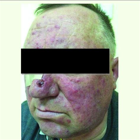 Species Distribution Of Demodex Mites Among Group I Patients With Rosacea Download Scientific