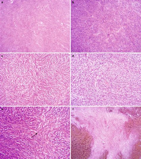 Ovarian Sex Cord Stromal Tumors Basicmedical Key