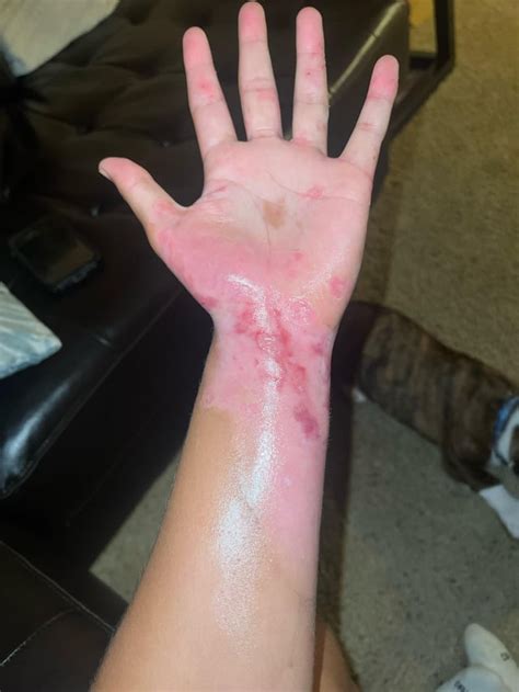 2nd Degree Burn Rburnsurvivors