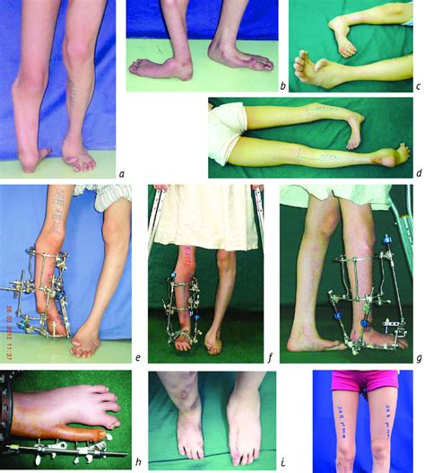 Ilizarov In Action Correction Of Shear Tibial Deformity