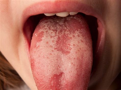 Red Spots On Tongue Std