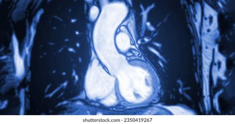 Mri Heart Cardiac Mri Magnetic Resonance Stock Illustration 2350419267