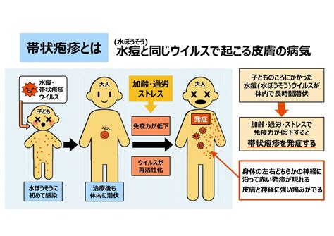 帯状疱疹ワクチンの定期接種令和7年4月から 下野市 市政トップページ