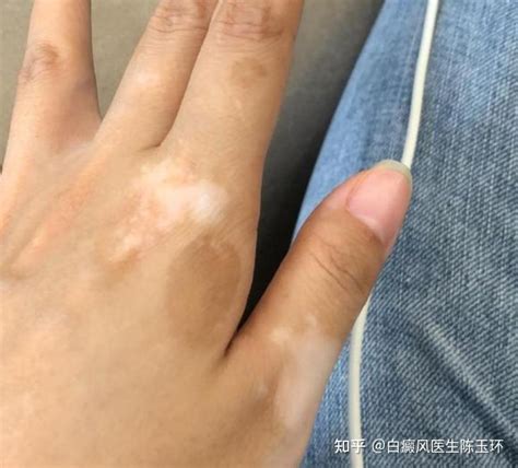 补骨脂泡酒能治白癜风迷信偏方祛白之路困难重重 知乎