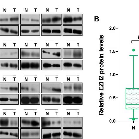 Ezh2 Protein Expression In Selected Pairs Of Colorectal Carcinomas A Download Scientific