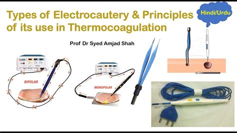 Types Of Electrocautery And Principles Of Its Use In Thermocoagulation Syed Amjad Shah Youtube