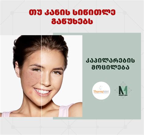 Aesthetic Center Mm ⭐ თერმავეინი თანამედროვე უმტკივნეულო და ეფექტური მეთოდი კაპილარების