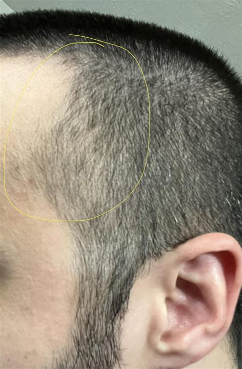 Could Minoxidil Help Me Regrow Thicker Hair In The Circled Area R