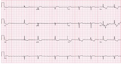 Digoxin Ekg