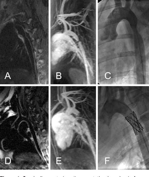 figure 1 from real time magnetic resonance imaging guided stenting of aortic coarctation with