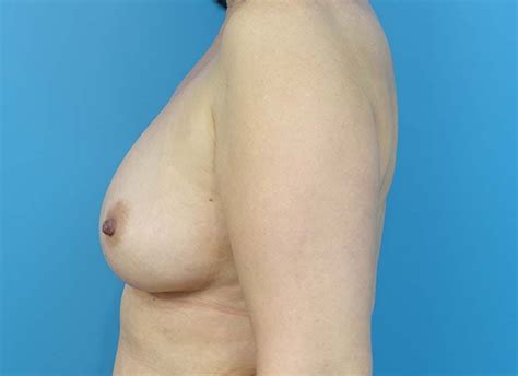 Patient 112338052 Hybrid Reconstruction Gallery Before And After Photos Neil Tanna