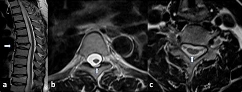 T2 Weighted Images View Compression Fracture Of T7 Vertebrae Arrow In Download Scientific