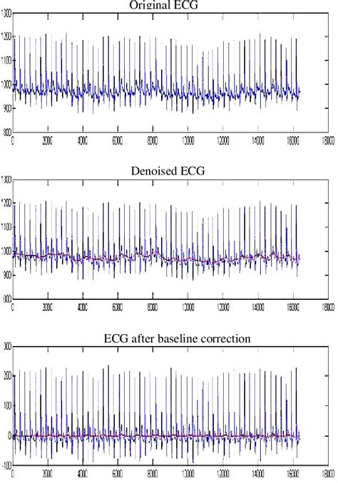 Figure 4 From An Adaptive Compression Algorithm For Ecg Signals