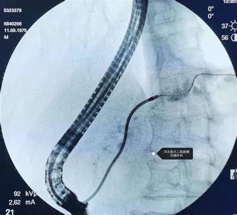 慢性胰腺炎合并胰腺假性囊肿的内镜下治疗