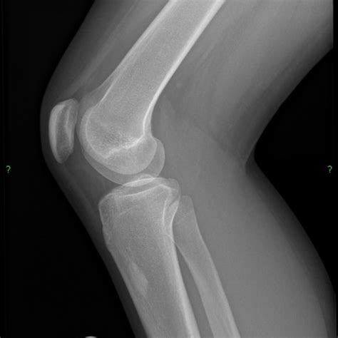 Osgood Schlatter Disease Avulsion Lesion Of The Tibial Tuberosity The