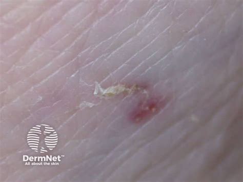 Nodular Scabies Dermnet
