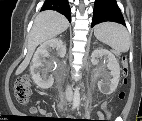 Pyelitis Involving Both Renal Pelvises And Ureters Simulates A Transitional Cell Cancer Tcc
