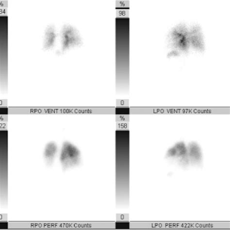Ventilation Perfusion Scan Showing A Large Mismatched Wedge‐shaped Download Scientific Diagram