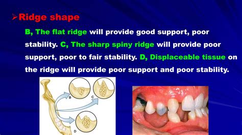 5 Basic Principles For Designing The Removable Partial Denture Class
