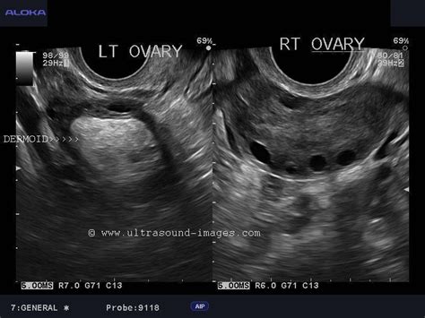 A Gallery Of High Resolution Ultrasound Color Doppler 3d Images Ovaries Artofit