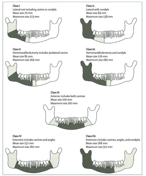 Classification Defect Of Mandible 13 Download Scientific Diagram