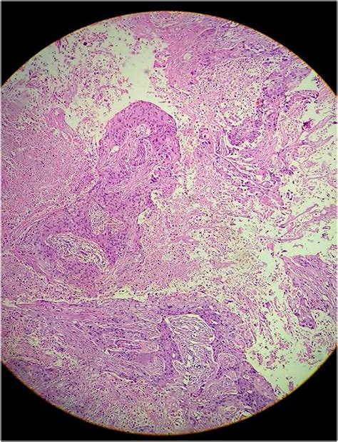 Histology Of Choledochal Cyst Showing Atypical Squamous Cell Arranged