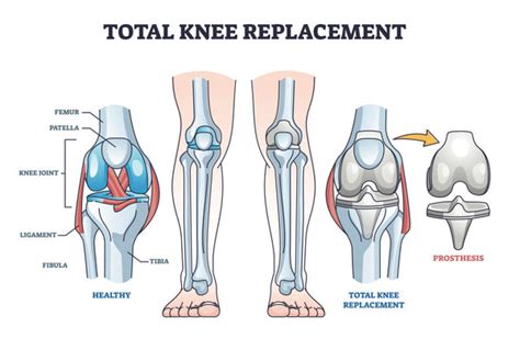 Knee Replacement Cost And Knee Replacement Alternatives To Consider Functional Patterns