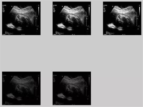Enhancement Of Bone Fracture Image Using Filtering Techniques Ppt