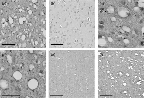 Complex Proteinopathy With Accumulations Of Prion Protein Hyperphosphorylated Tau α Synuclein