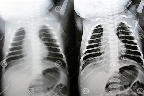 Una Radiografía De Tórax Simple Para Un Recién Nacido En Incubadora Con