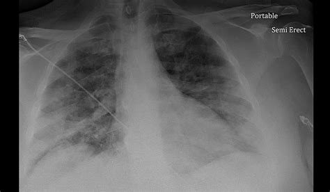 Chest X Ray Showing Bilateral Patchy Opacities Download Scientific