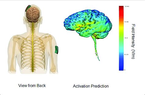Dlpfc Montage Images Display The Dlpfc Tdcs Montage With Anode On
