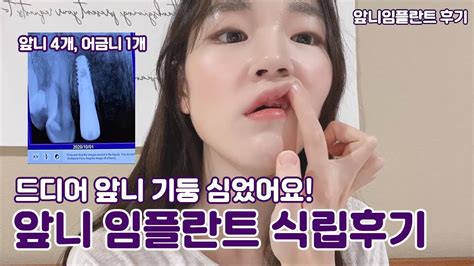 앞니 임플란트 식립후기🦷ㅣ임플란트 기둥 심었어요 Youtube