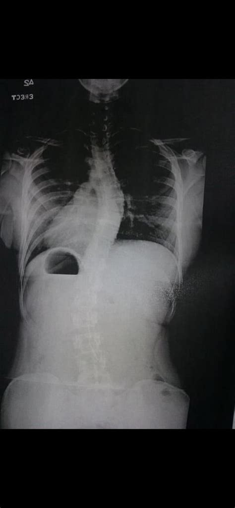 Spinal Anesthesia Possible With A Fused Spine R Spinalfusion