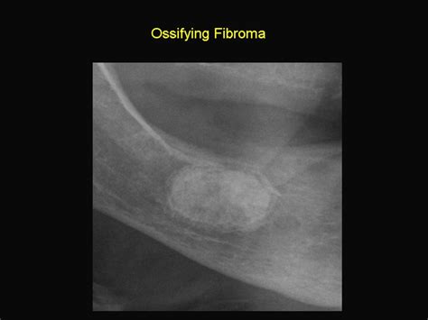 Cemento Ossifying Fibroma In An Elderly Female Note The Radiolucent