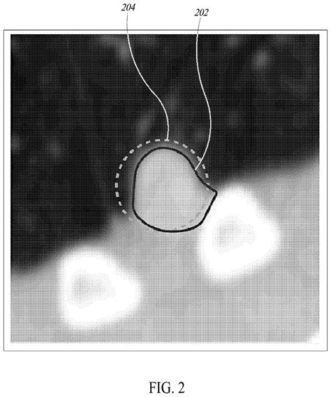 Lesion Detection Patented Technology Retrieval Search Results Eureka Patsnap